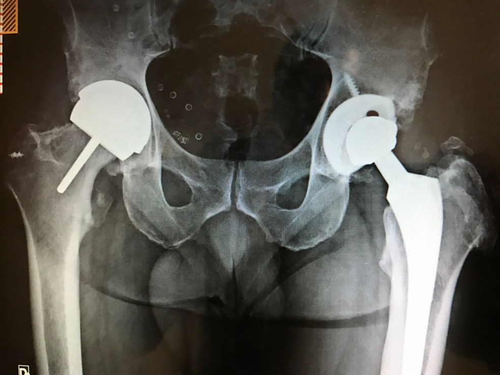 Com 2 próteses de quadril e aos 65 anos, brasileiro já correu mais de ...