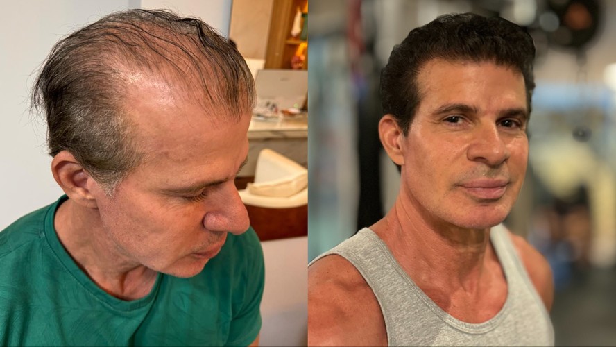Faloplastia Antes E Depois Preenchimento De Pênis: Os Riscos Da