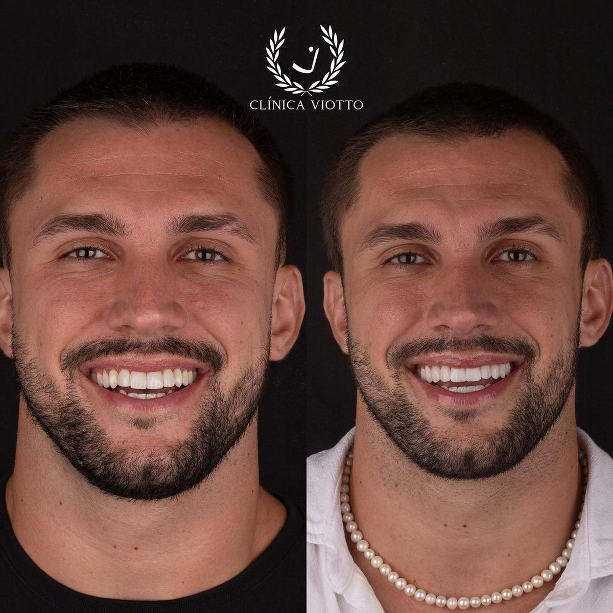 Arthur Picoli passa por procedimento para 'consertar' sorriso; veja ...