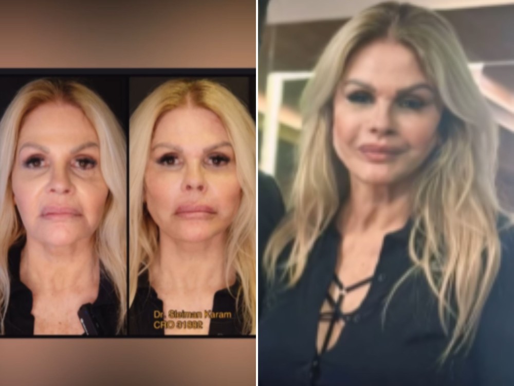 Monique Evans passa por mais um procedimento no rosto para casamento ...